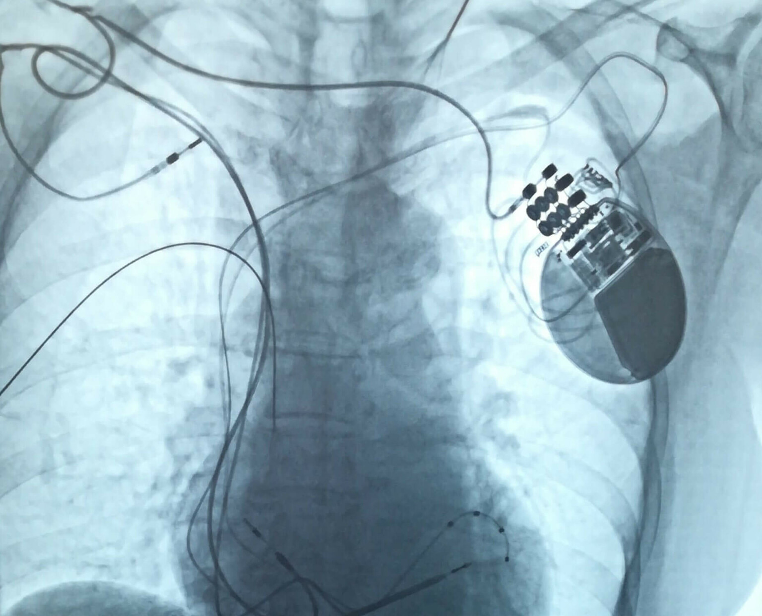 Pacemakers: types, usage & precautions | TauroPace™